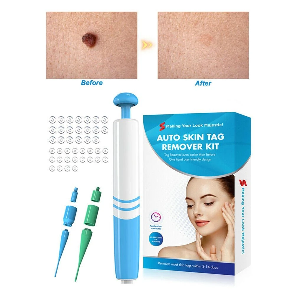 Skin Tag Remover Mole Remover Skin Tag Removal Kit Auto Tag Remover ...