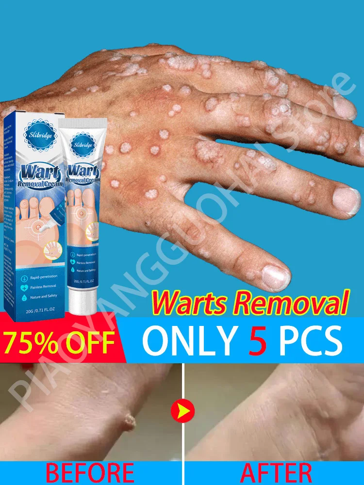 Wart-Remover-Ointment-For-Anti-Warts-Remove-Skin-Tag-Filiform-Plantar-Genital-Flat-Periungual ...