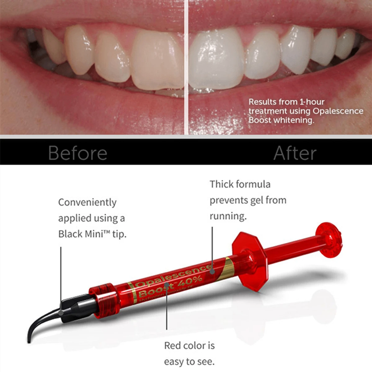Opalescence Boost Teeth Whitening Shoreline