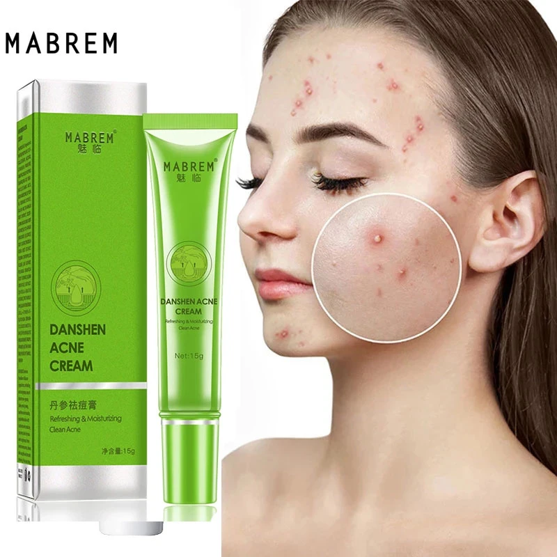 Effective Acne Removal Cream Treatment Fade Spots Oil Control Shrink ...