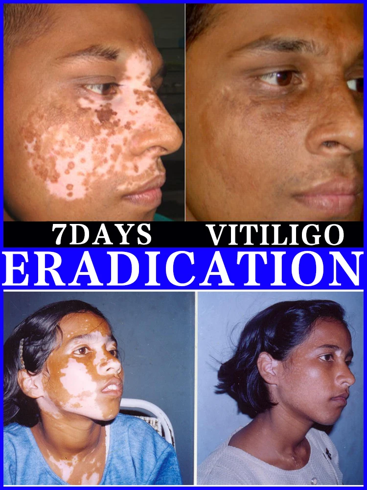 7-day-fast-eliminate-vitiligo-cream-effectively-resists-white-spot-and ...