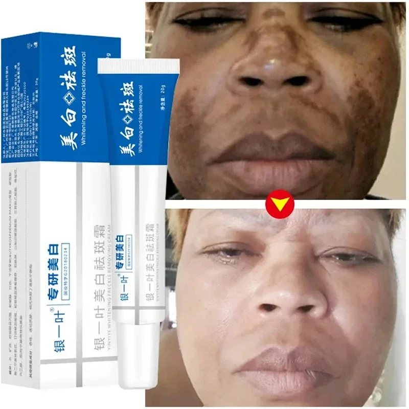 Whitening-Blemish-Cream-Effectively-Removes-Melasma-Dark-Spots-Fade ...
