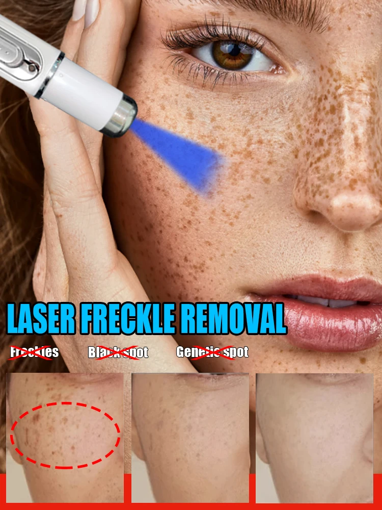 Laser-Dark-Spots-Melasma-Freckles-Face-Whitening.jpg