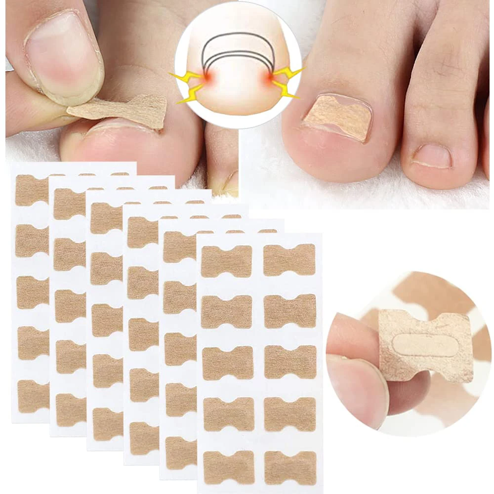 50/100pcs Ingrown Toenail Corrector Patches Nail Correction Care ...