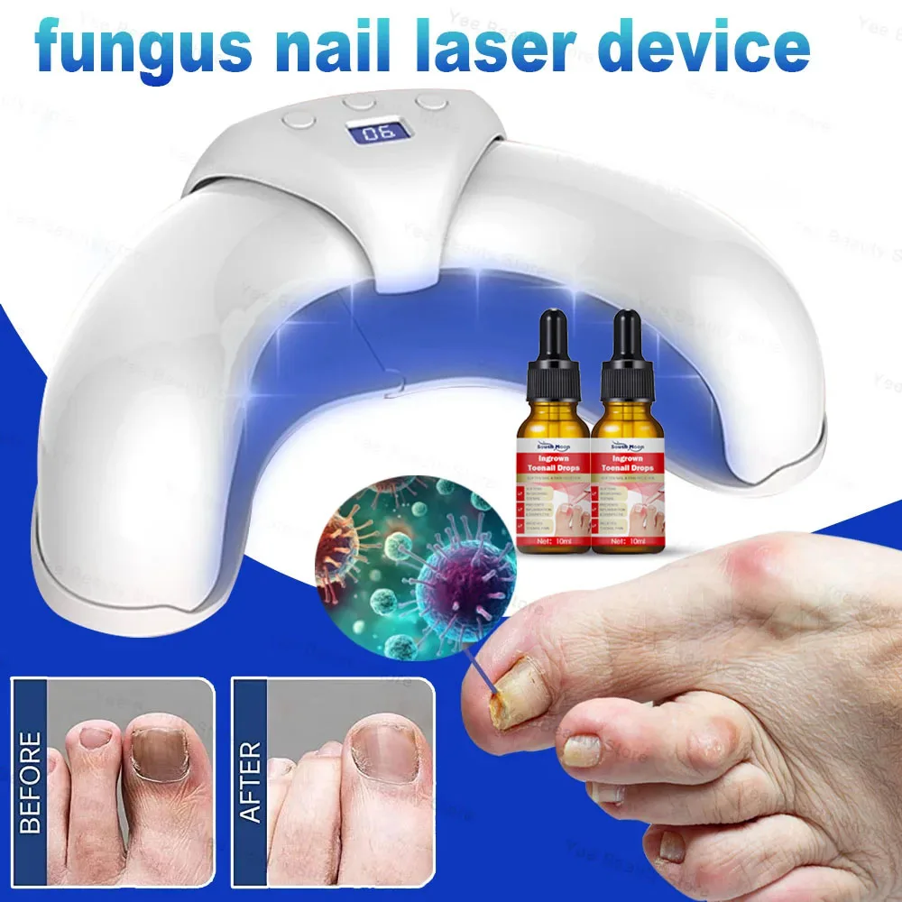 Fungal-Nail-Laser-Device-Repair-Fast-Nails-Fungus-Onychomycosis-Repair ...
