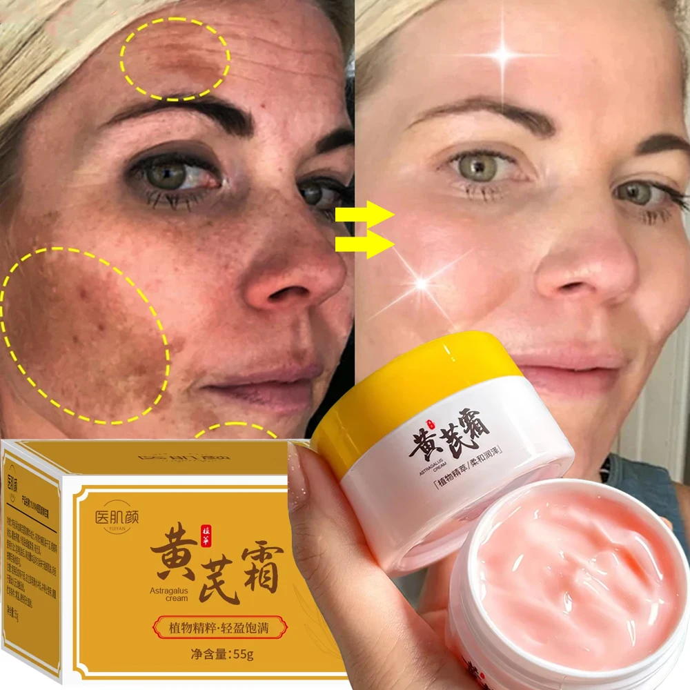 Astragalus Whitening Freckles Face Cream Remove Dark Spots Melasma ...