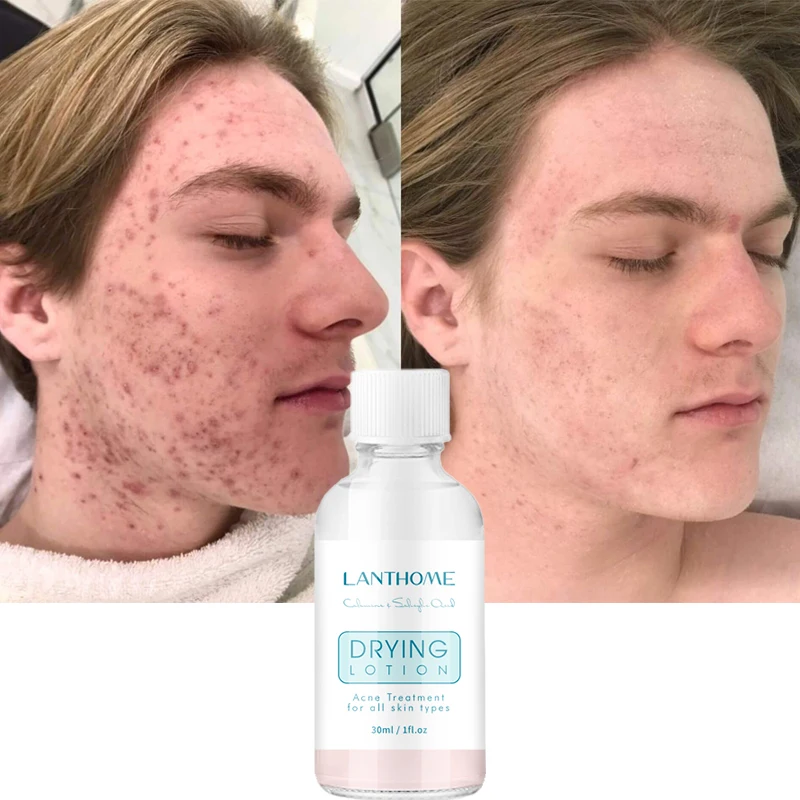Calamine Lotion Acne