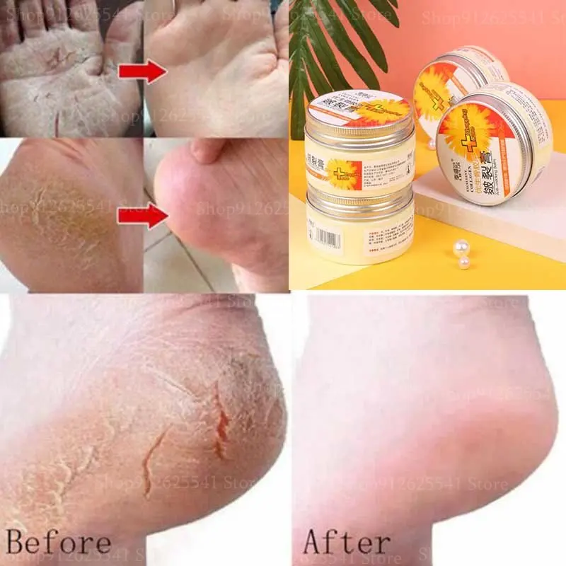 Anti cracked Foot Cream Dry Heel Crack Repair CreamCollagen Cracked ...