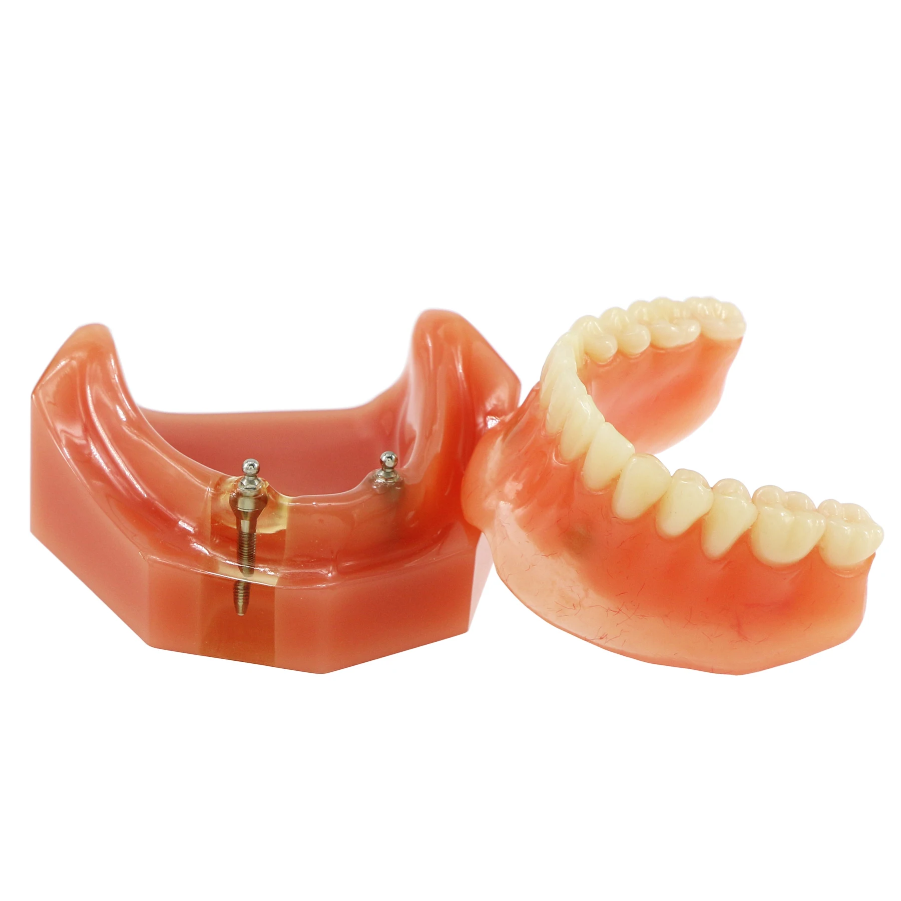 Dental-Implant-Overdenture-Teeth-Model-2-Implants-Typodont-M6007 ...