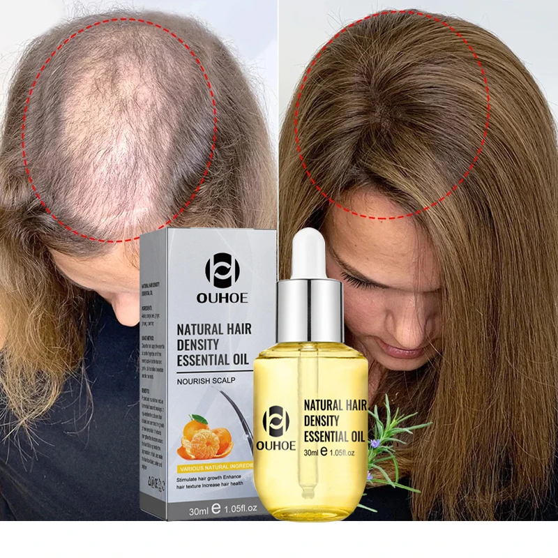 Natural-Ginger-Hair-Growth-Products-For-Men-And-Women-Anti-Hair-Loss ...