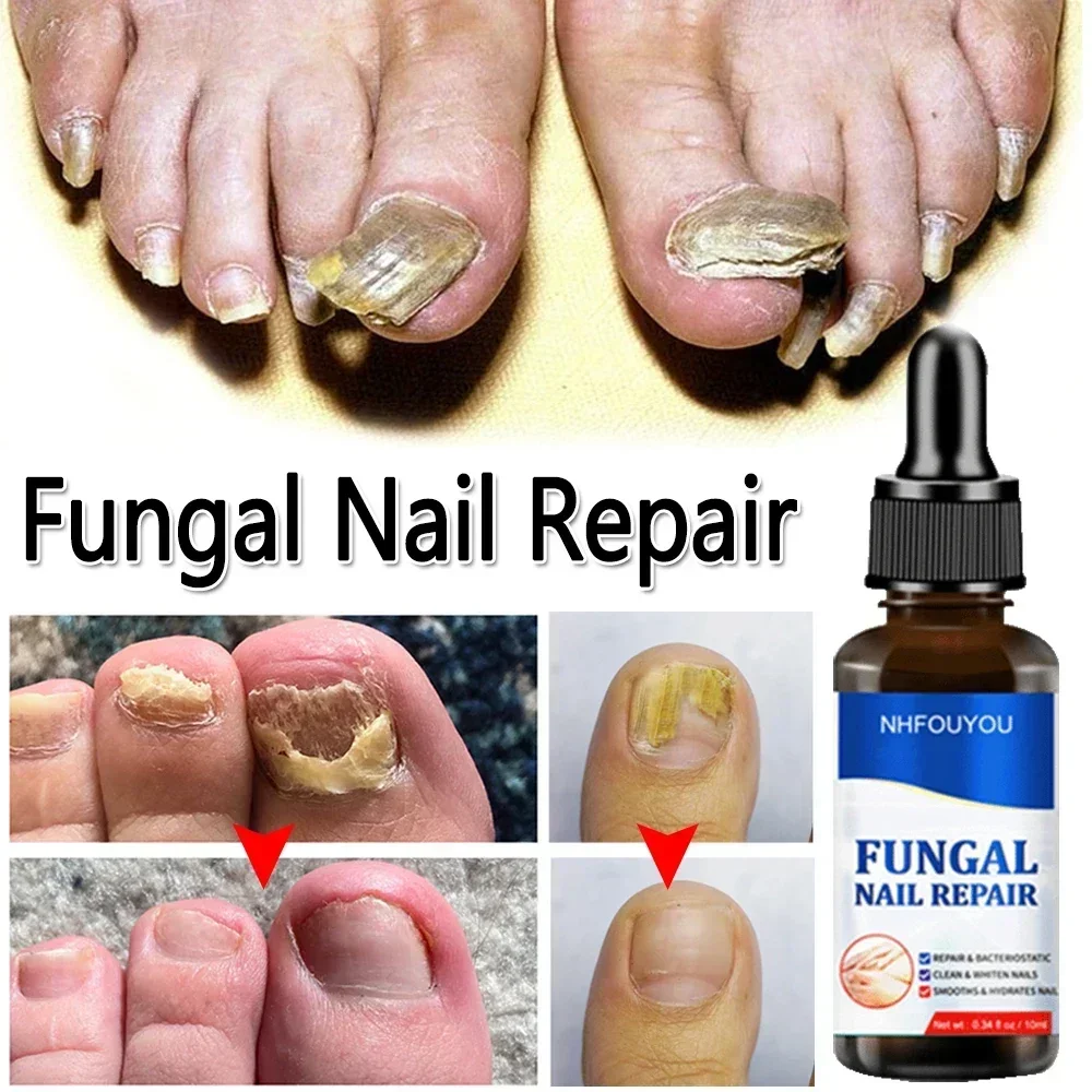 Líquido de reparación de uñas, líquido para uñas descoloridas, gruesas ...