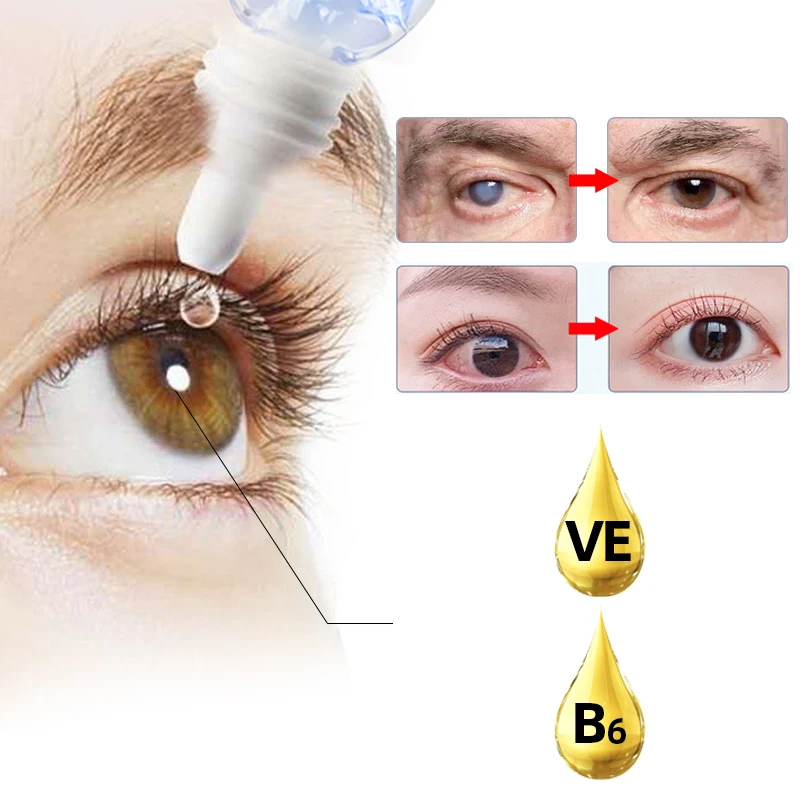 Cataract Treatment Medical Eye Drops Apply To Blurred Vision ...