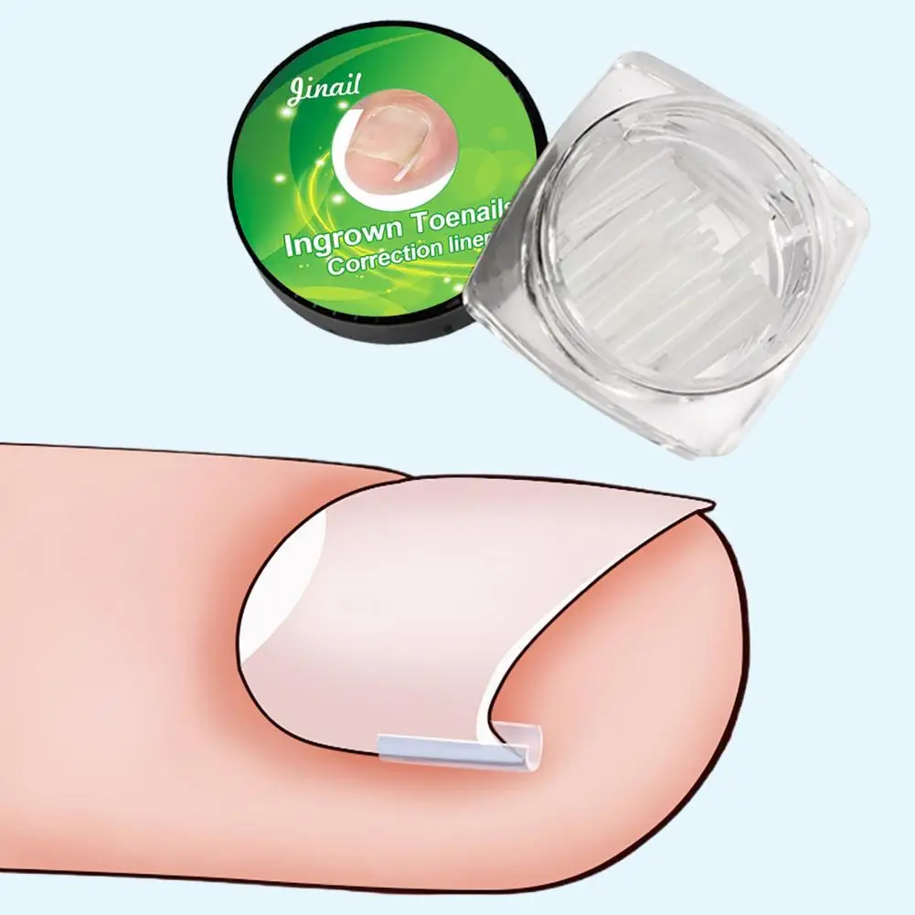 10Pcs-Box-Toenail-Patch-Mini-Nail-Correction-Sticker-Flexible-Useful ...