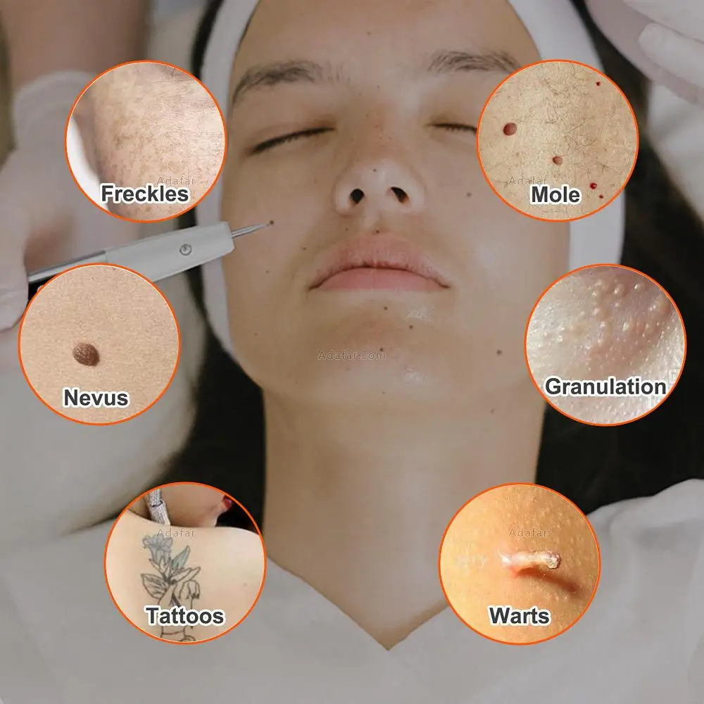 Gold-3-10-99 - Kit de stylo laser électrique pour l'élimination des ...