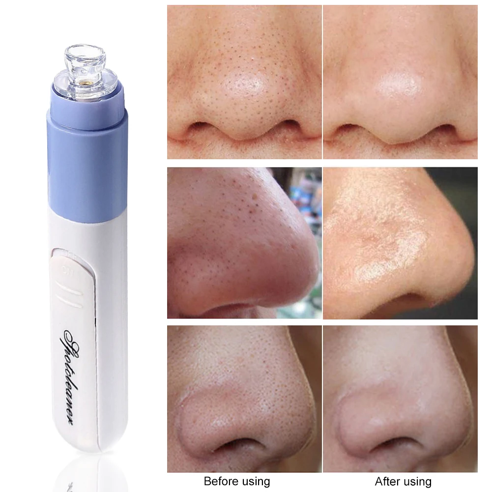 Mini-Face-Pore-Cleaner-Blackhead-Remover-Vacuum-Acne-Pimple-Removal ...