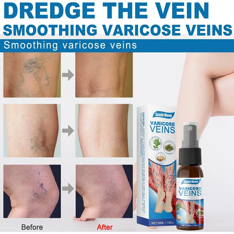 Varicose Veins Relief Spray Varicose Veins Cream Vasculitis Phlebitis ...