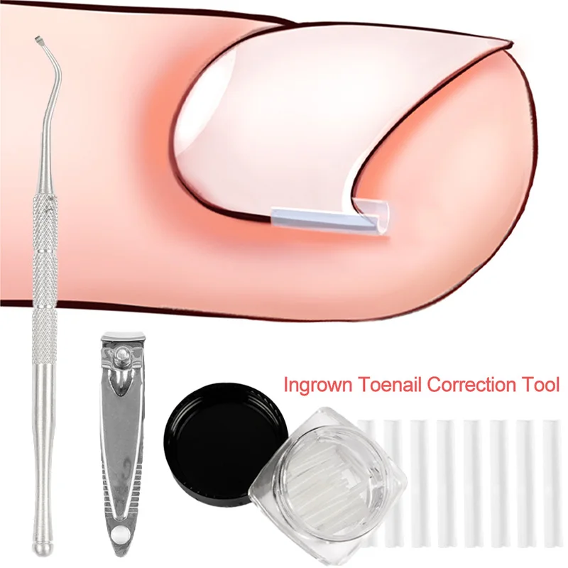 10-30pcs-Ingrown-Toenail-Correction-Tool-Ingrown-Toe-Nail-Treatment ...