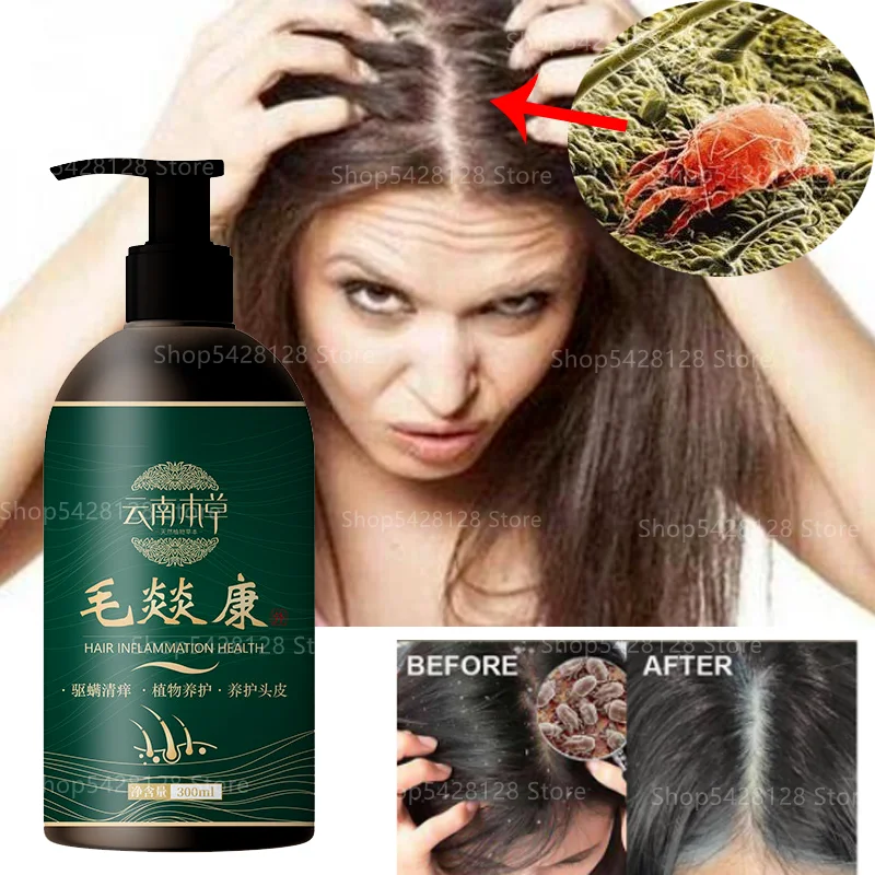 Scalp Folliculitis Refreshing Maintenance Scalp Shampoo Tinea Capitis ...