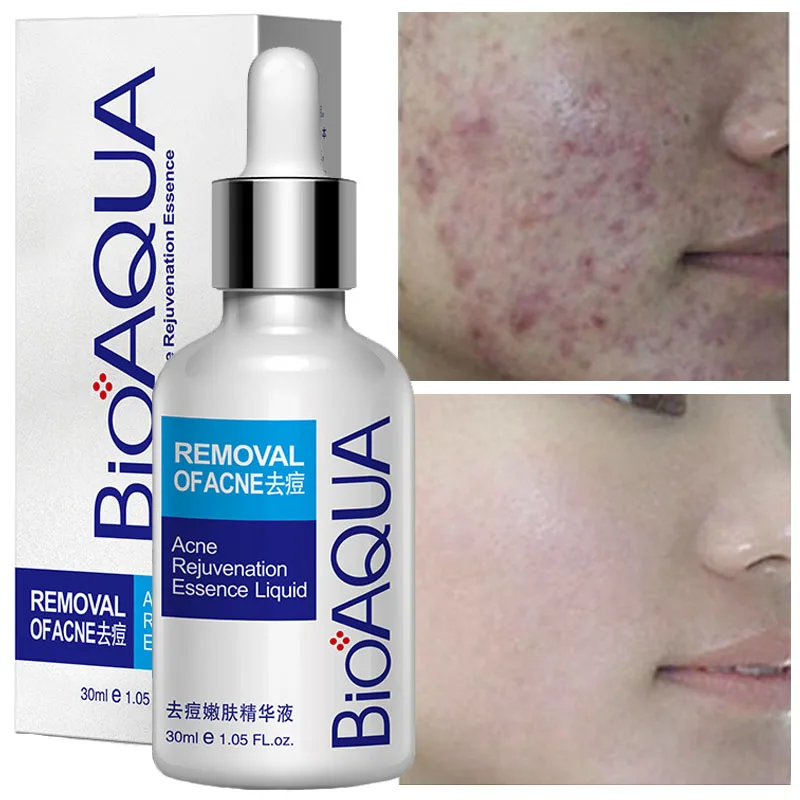 Acne-Removal-Facial-Serum-Anti-Acne-Treat-Acne-Scar-Pore-Shrinking-Oil ...