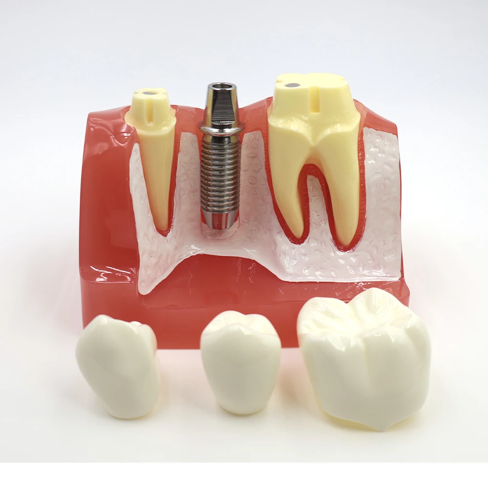 Dental-Implant-Analysis-Crown-Bridge-Demonstration-Teeth-Tooth-Study ...