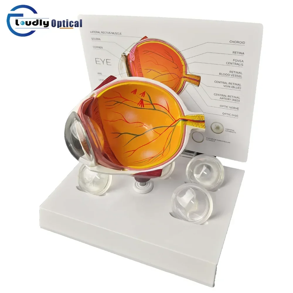 4X-Cataract-Eyeball-Model-Shows-Internal-Structure-of-The-Eye-Various ...