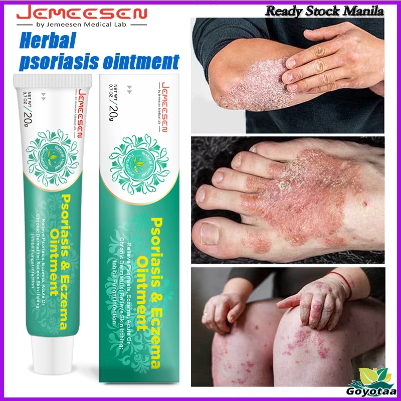 Jemeesen Psoríase Creme Eczema Pomada Coceira Alívio Tratamento Mão ...
