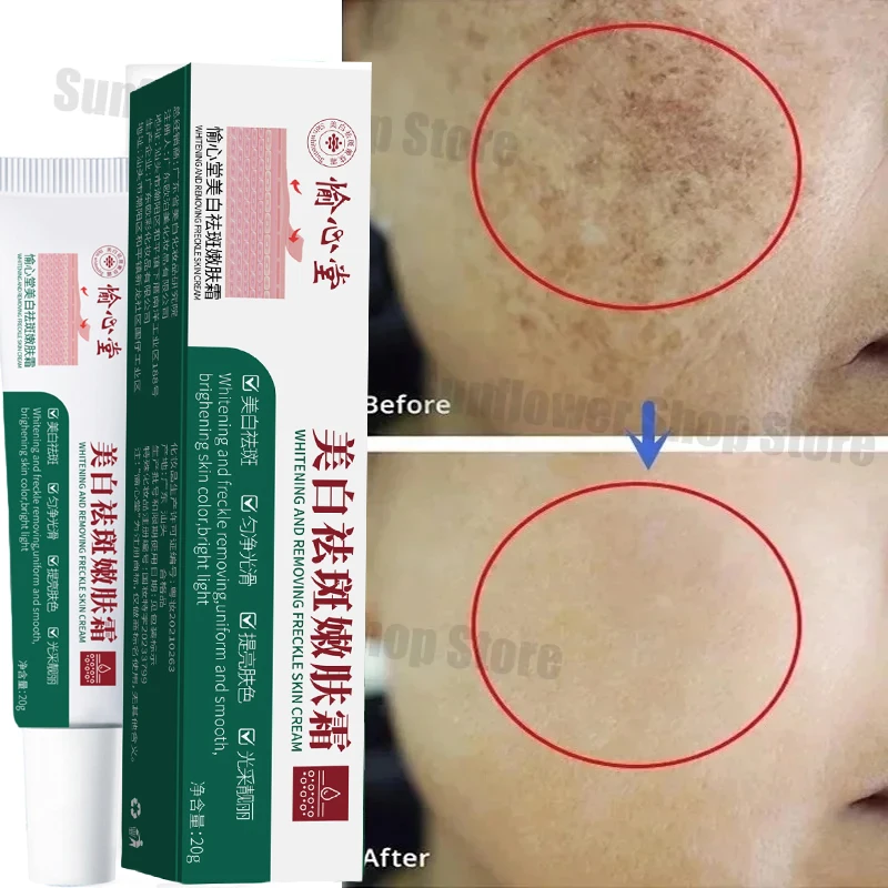 Effective-Whitening-Freckle-Cream-Remove-Dark-Spot-Cream-Removal ...