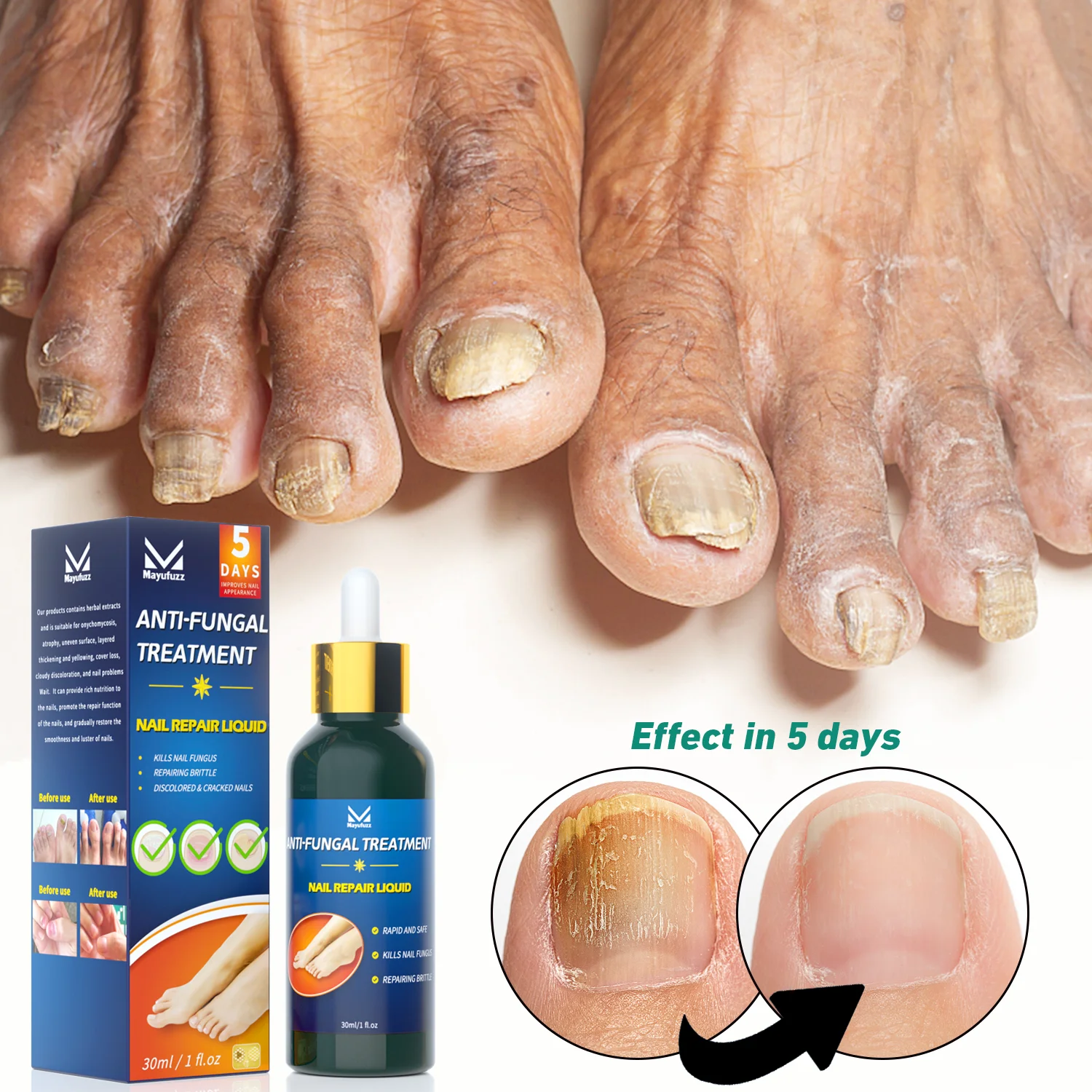 Nail Fungus Treatments Serum Repair Toe Nails Fungal Removal Essence ...