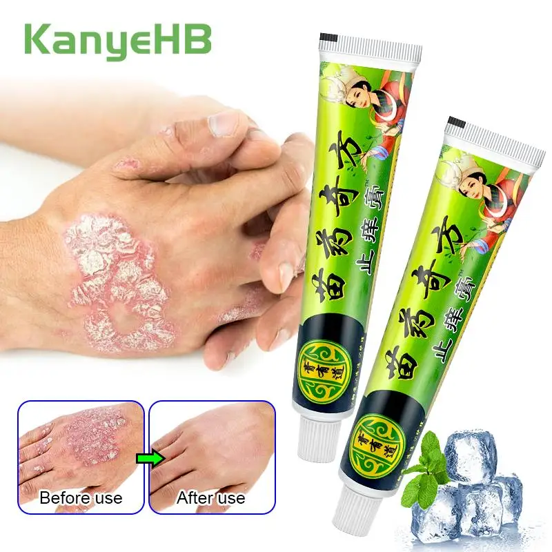 Crema-para-Psoriasis-Dermatitis-Eczema-Tinea-Pedis-tratamiento-de-mano ...