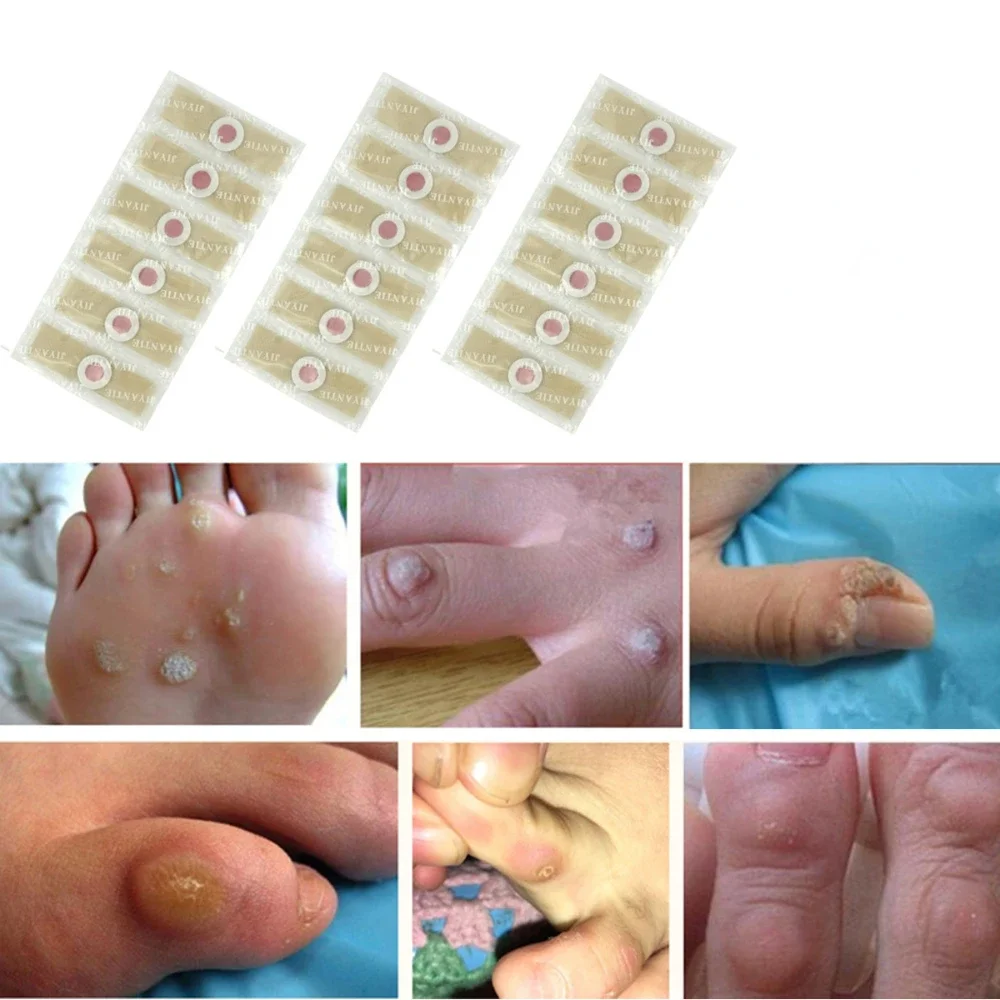 24PCS-Medical-Corn-Plaster-Foot-Corn-Removal-Warts-Thorn-Detox-Adhesive ...
