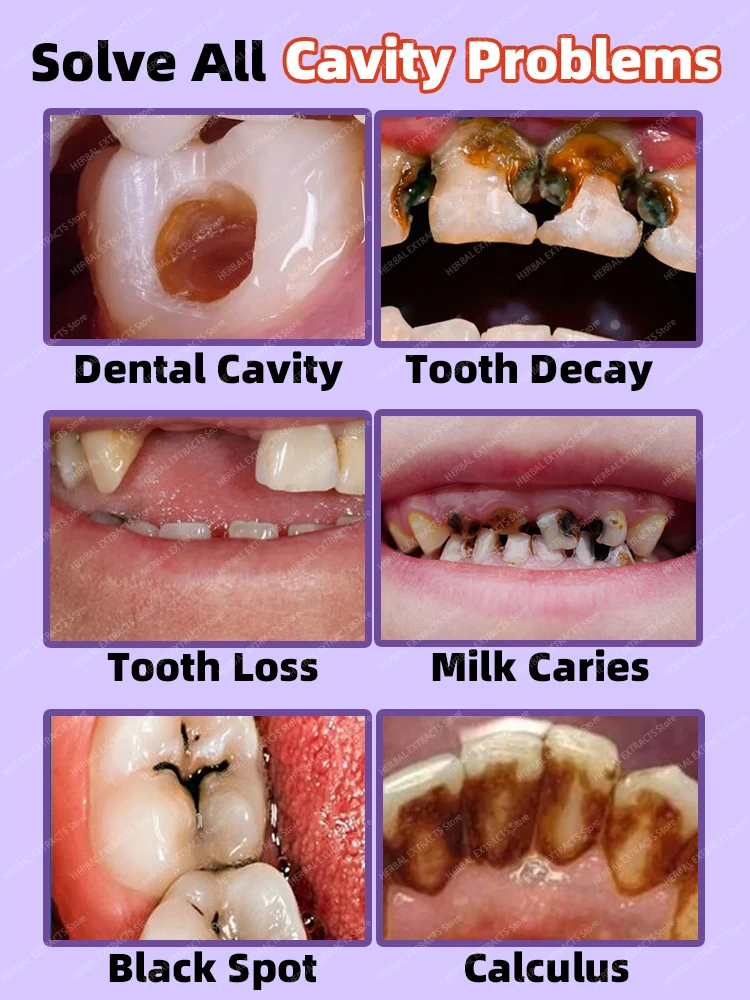 Reliable-Dental-paste-Prevent-Tooth-Decay-Dental-Caries-Whitening-Teeth ...