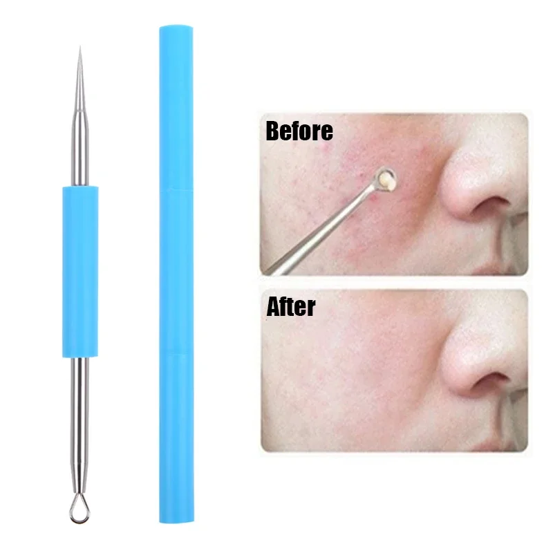 1PC-Acne-Clip-Set-Cell-Clip-Acne-Needle-Squeezing-Blackhead-Pressing ...