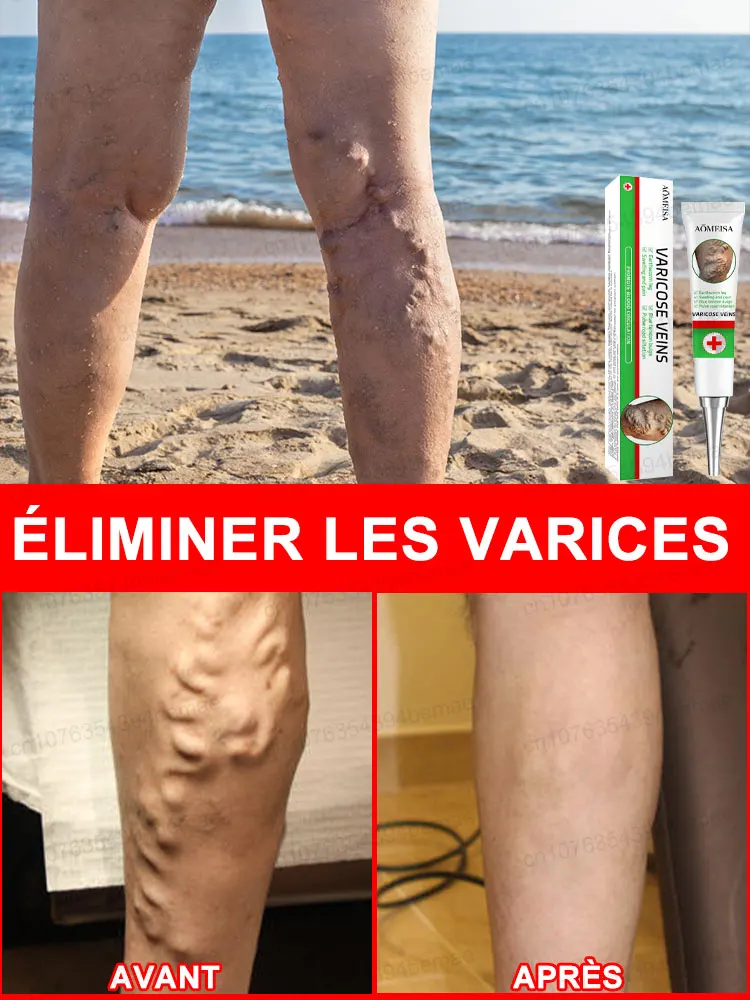 Cr-me-efficace-pour-les-varices-pommade-pour-les-varices-jusqu ...