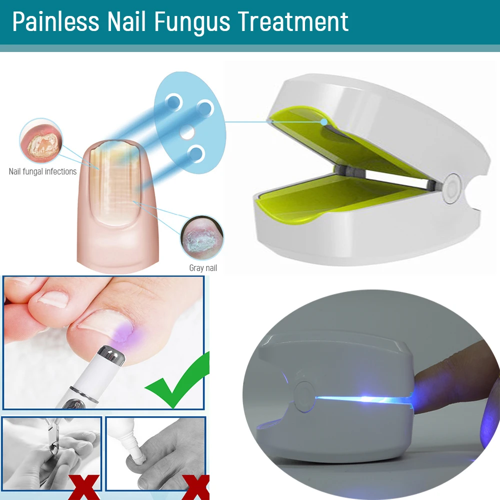 905NM-Nail-Fungus-Laser-Therapy-Device-Mini-Painless-Nail-Fungus ...