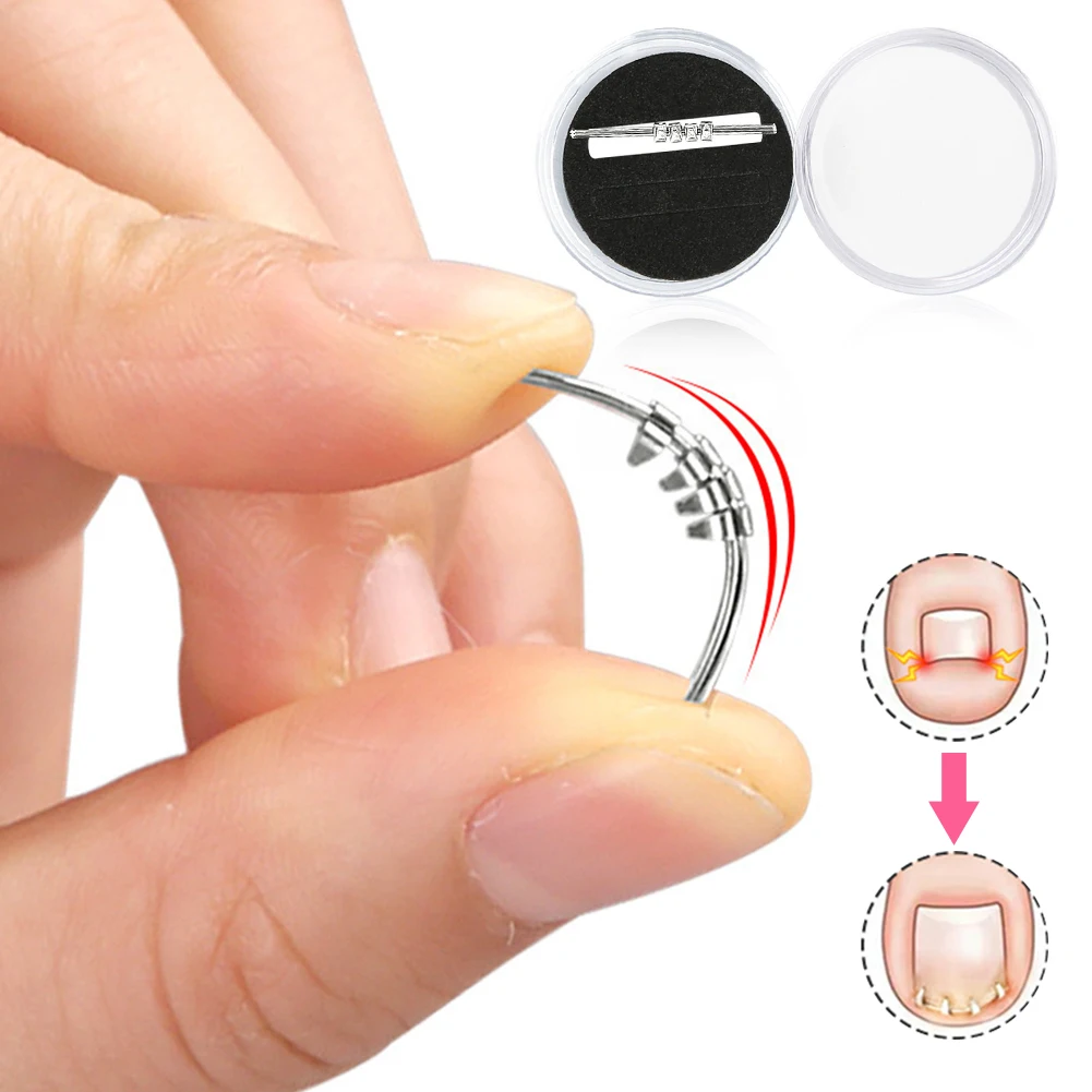Straightening-Correction-Clip-Ingrown-Toenail-Corrector-Tool-Embed-Toe ...
