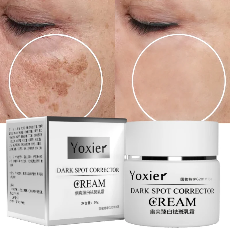 Moisturizing-Whitening-Freckles-Cream-Remove-Melasma-Dark-Spot-Acne ...