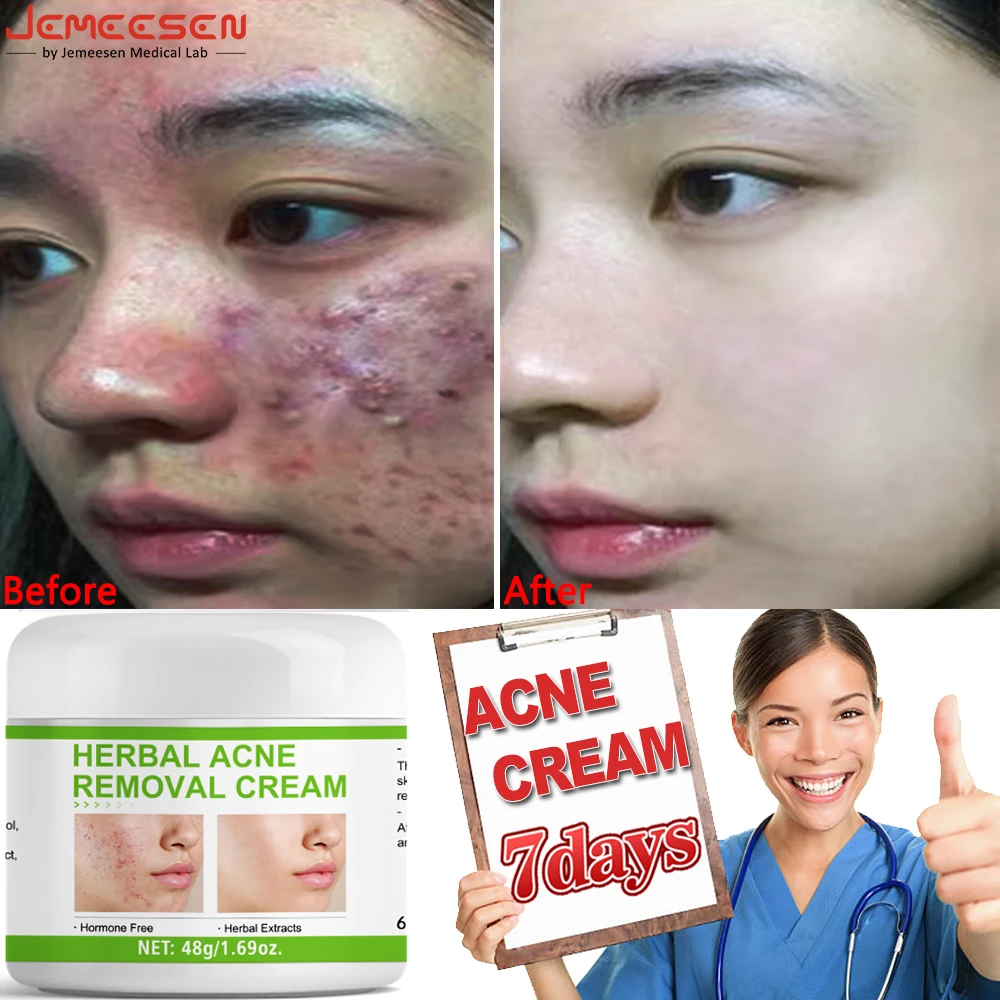 Jemeesen Acne Removal Face Cream Control Anti-acne Creamtreatment Acne Mark Skin Care Whitening ...