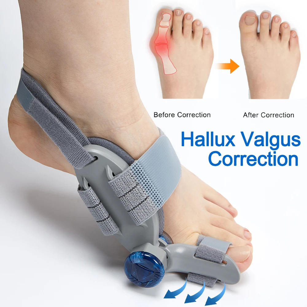 Hallux-Valgus-Correction-foot-corrector-Bunion-Splint-Big-Toe ...