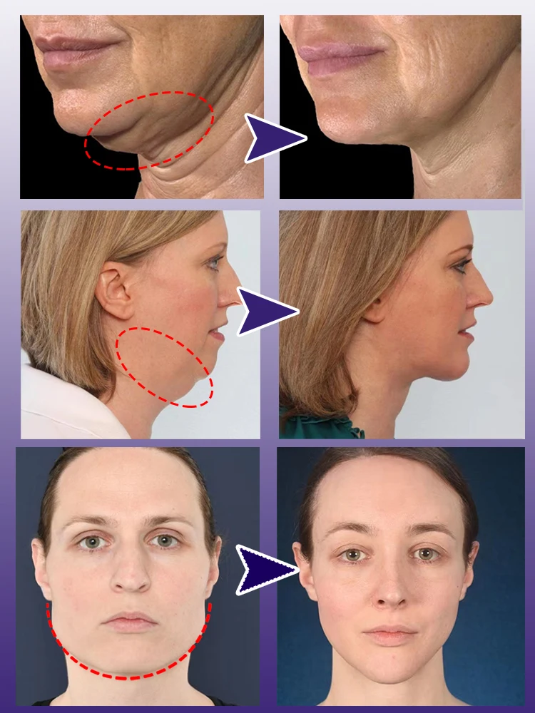 With Thin Double Chin