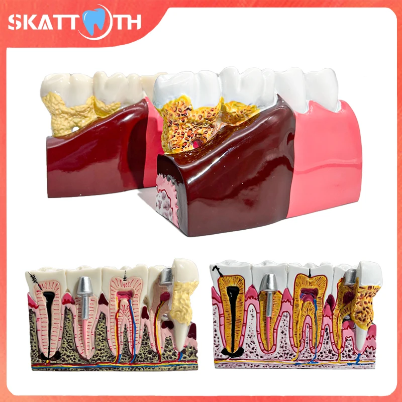 1Pcs Dental Model Caries Anatomy Model Comprehensive Pathology Tooth ...