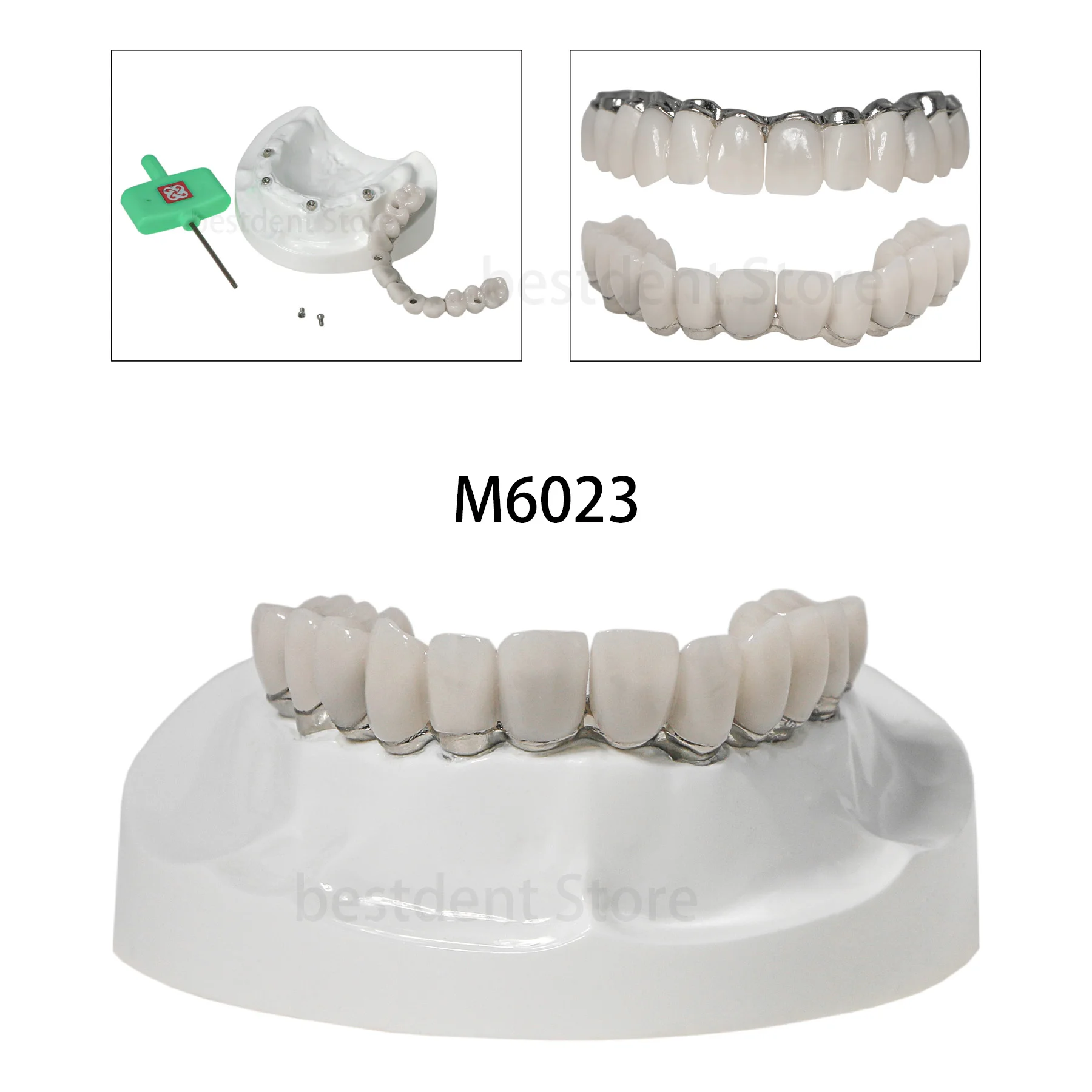 Dental-Implant-Teeth-Model-Overdenture-Upper-Jaw-Restoration ...