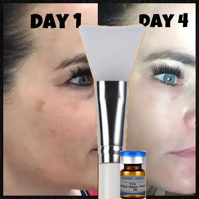 Tca-Peel-30-Acid-Face-Peeling-Spots-Exfoliating-Reduce-Wrinkles-Acne ...