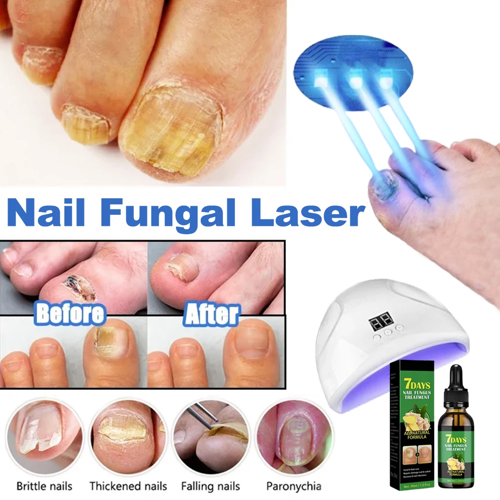 Fungal-Nail-Laser-Device-Repair-Fast-Nails-Fungus-Anti-Infection ...