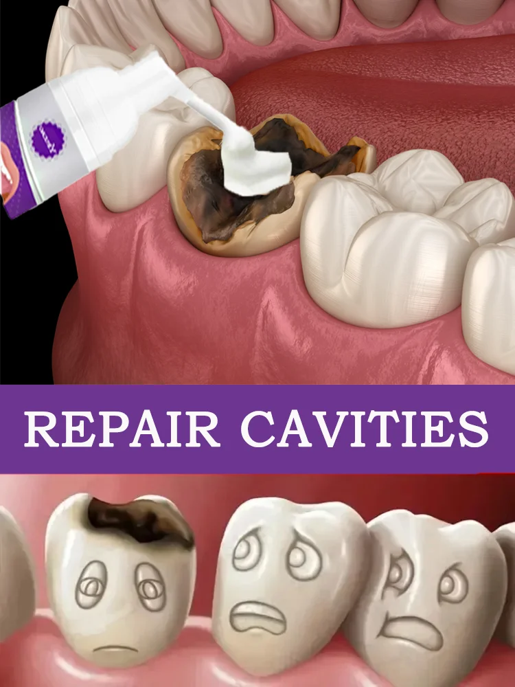 Tooth-decay-Repair-Repairing-Cavities-Protecting-Anti-Caries.png