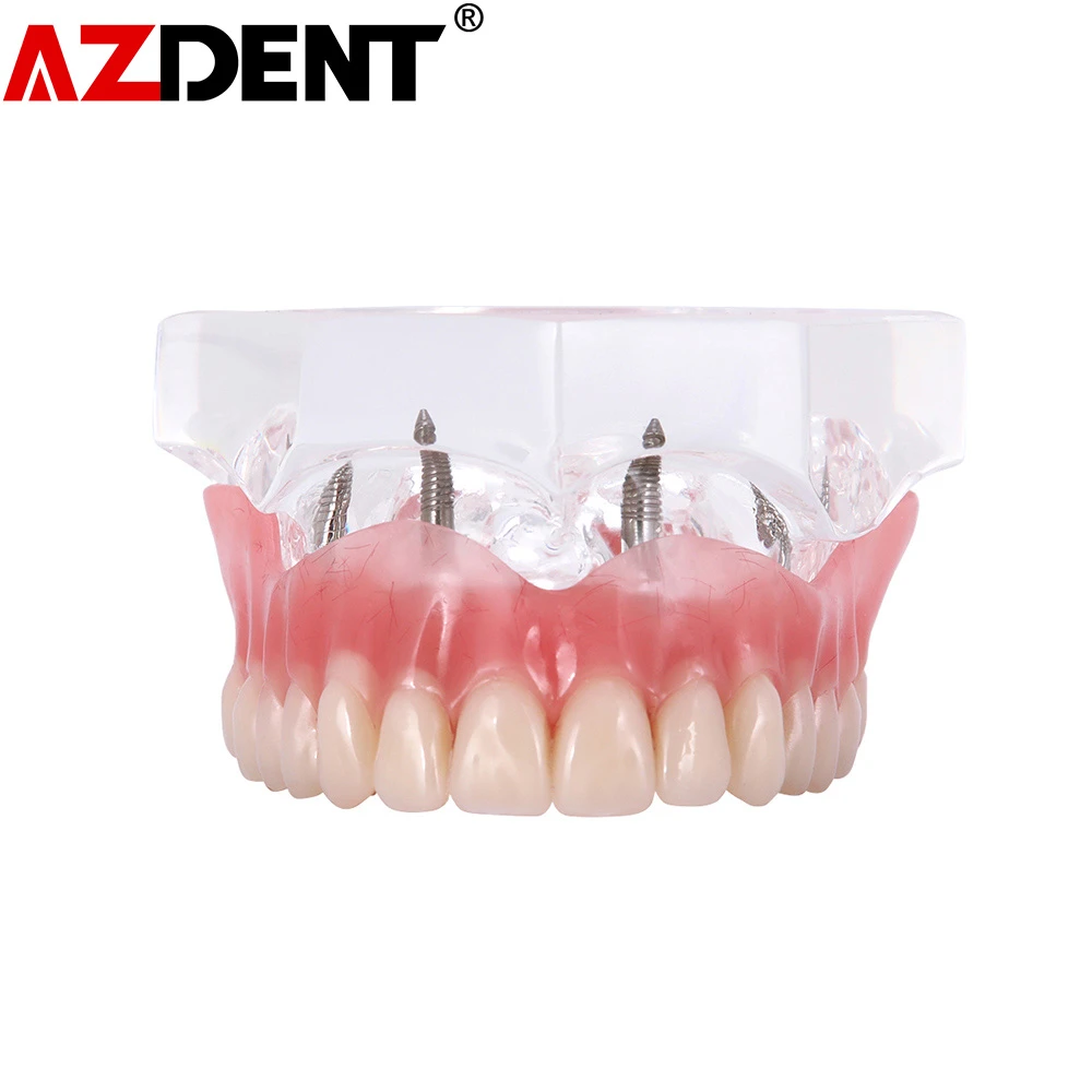 Dental Overdenture Teeth Model | Interior Mandibular | Lower Mandibular ...