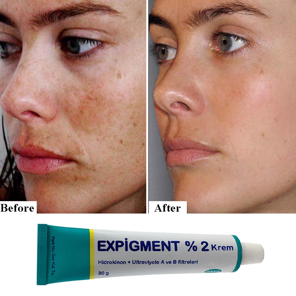 Expigment 30g 1oz Hydroquinone 2 % Cream For Skin Bleaching Skin ...
