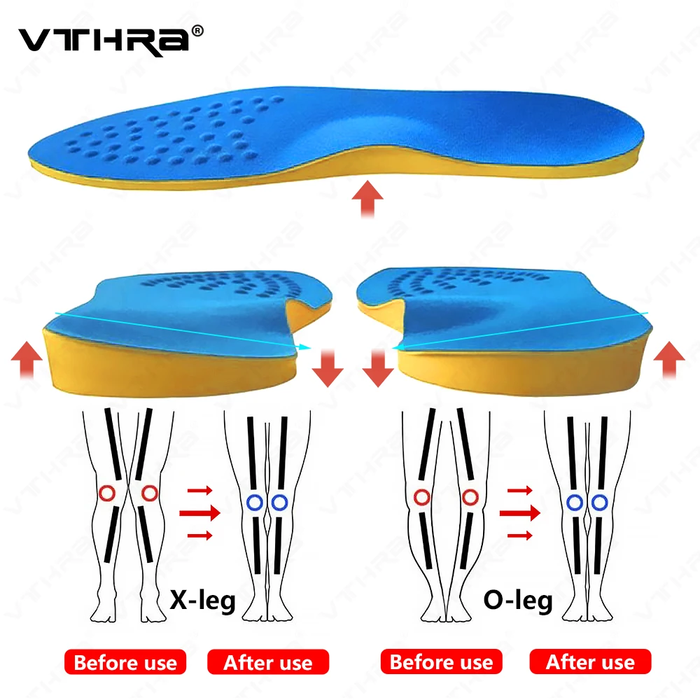 Orthopedic Insoles Varus | Insole Orthopedic X Legs | Orthopedic Foot ...