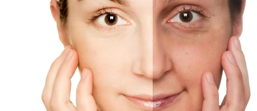 Expigment Hydroquinone 2% Cream For Skin Bleaching Skin Lightening Skin ...