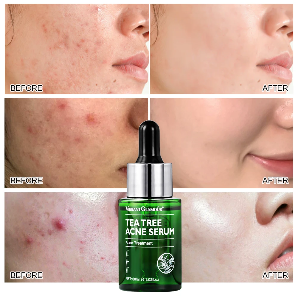 Tea Tree Oil For Acne Results