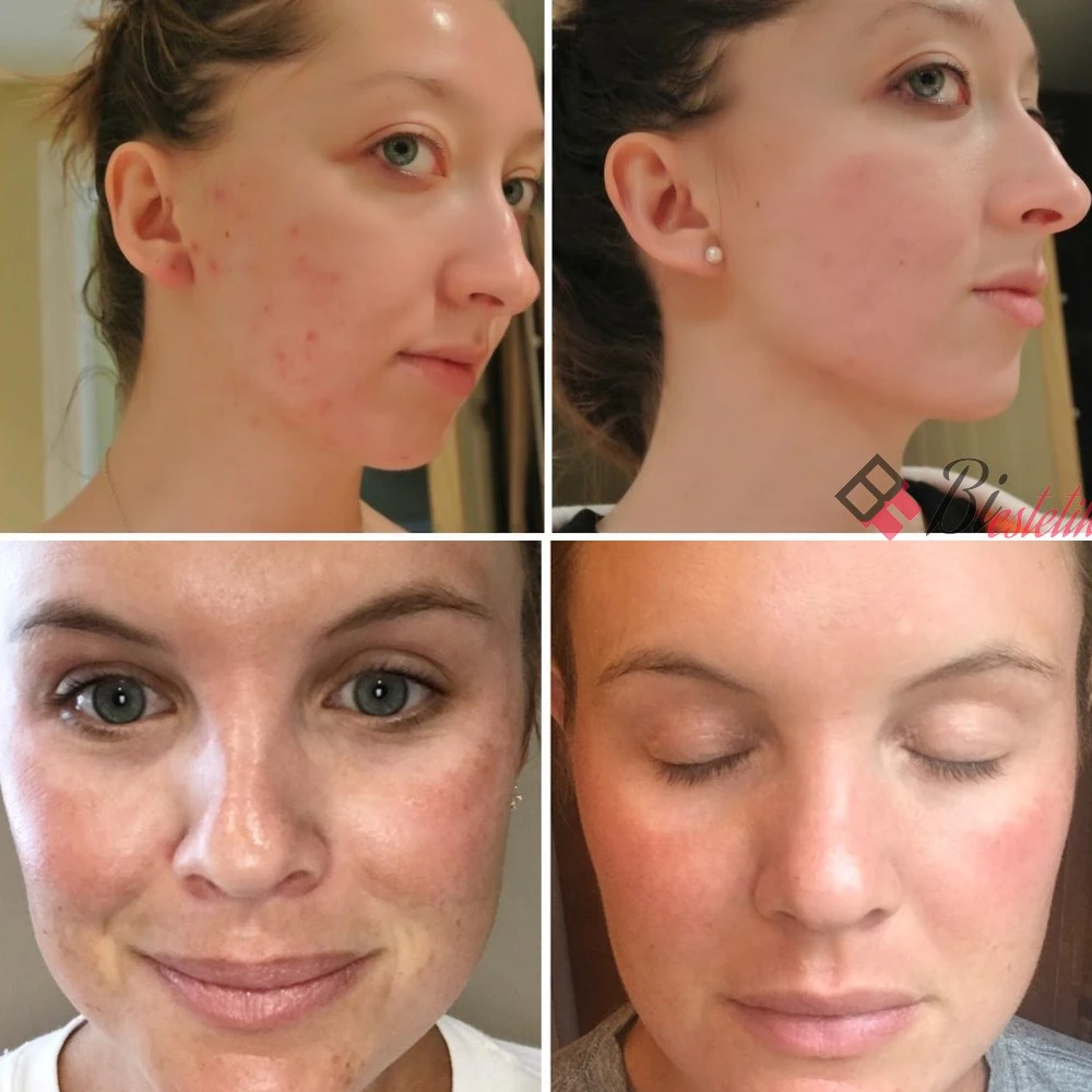 Expigment 30g 1oz Hydroquinone 2 % Cream For Skin Bleaching Skin ...